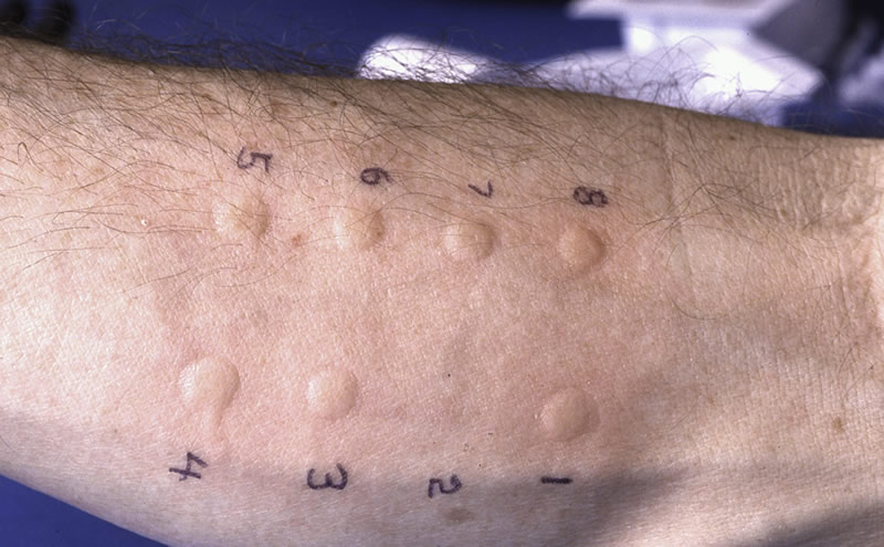 Allergieteststempel – Keils-Medizinbedarf